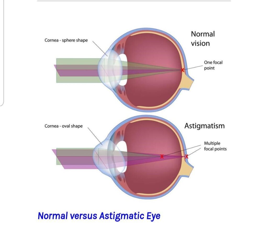 Children And Refractive Errors – Cypress Eye Centre
