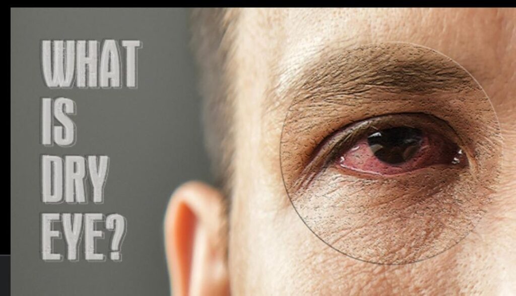 STRABISMUS (CROSSED EYES) – Cypress Eye Centre