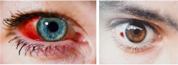 SUBCONJUNCTIVAL HEMORRHAGE – Cypress Eye Centre